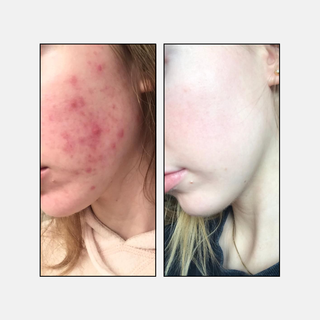 Anti Acné - Touché Skincare Lab